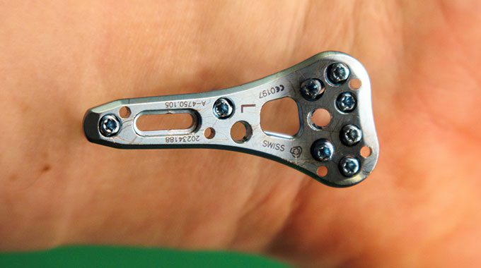 Small Bone, Big Challenge: Precision Machining for Micro Implants ...
